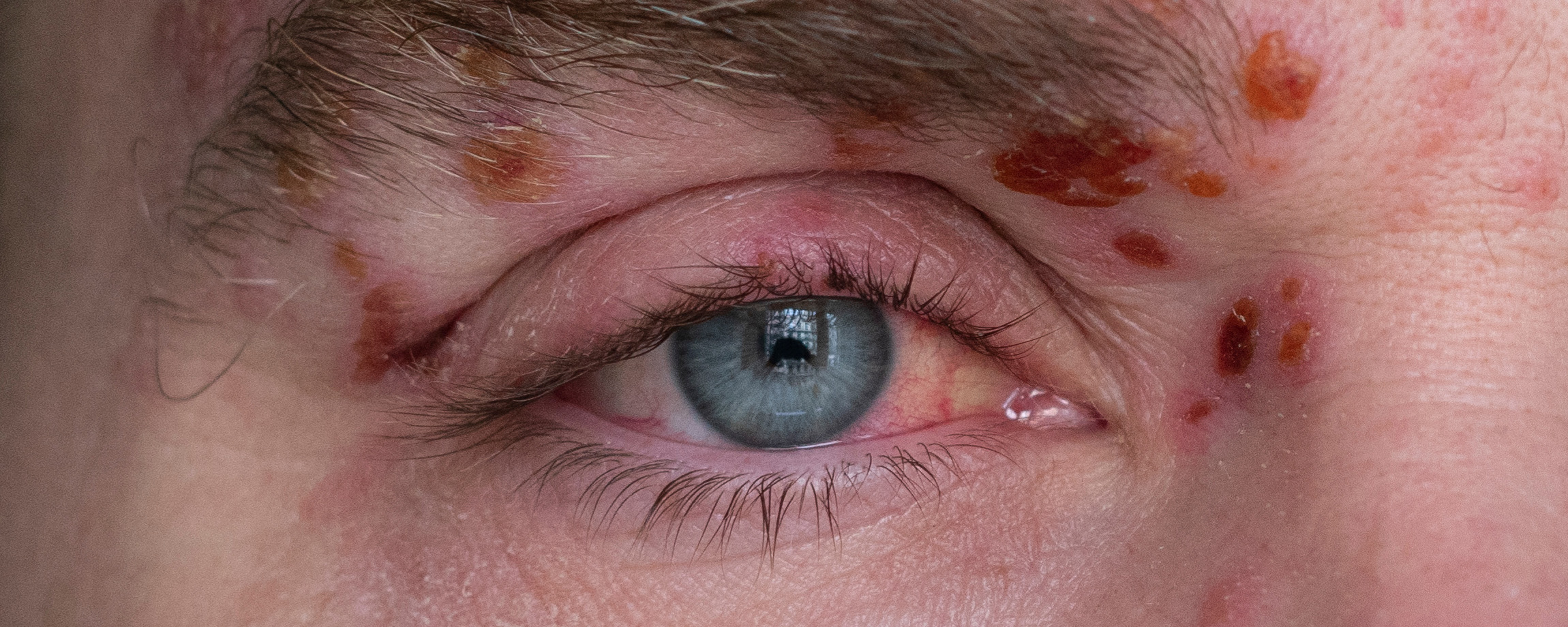 Herpes Zoster or Shingles Eye Disease - Clarity Eye Care & Surgery